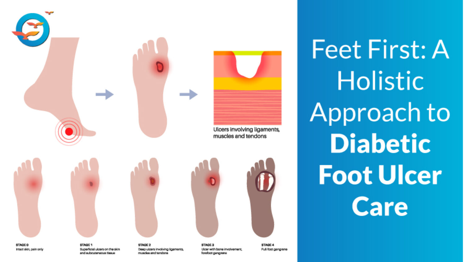 Understanding Diabetic Foot Ulcers: Causes and Treatments - ezine articles