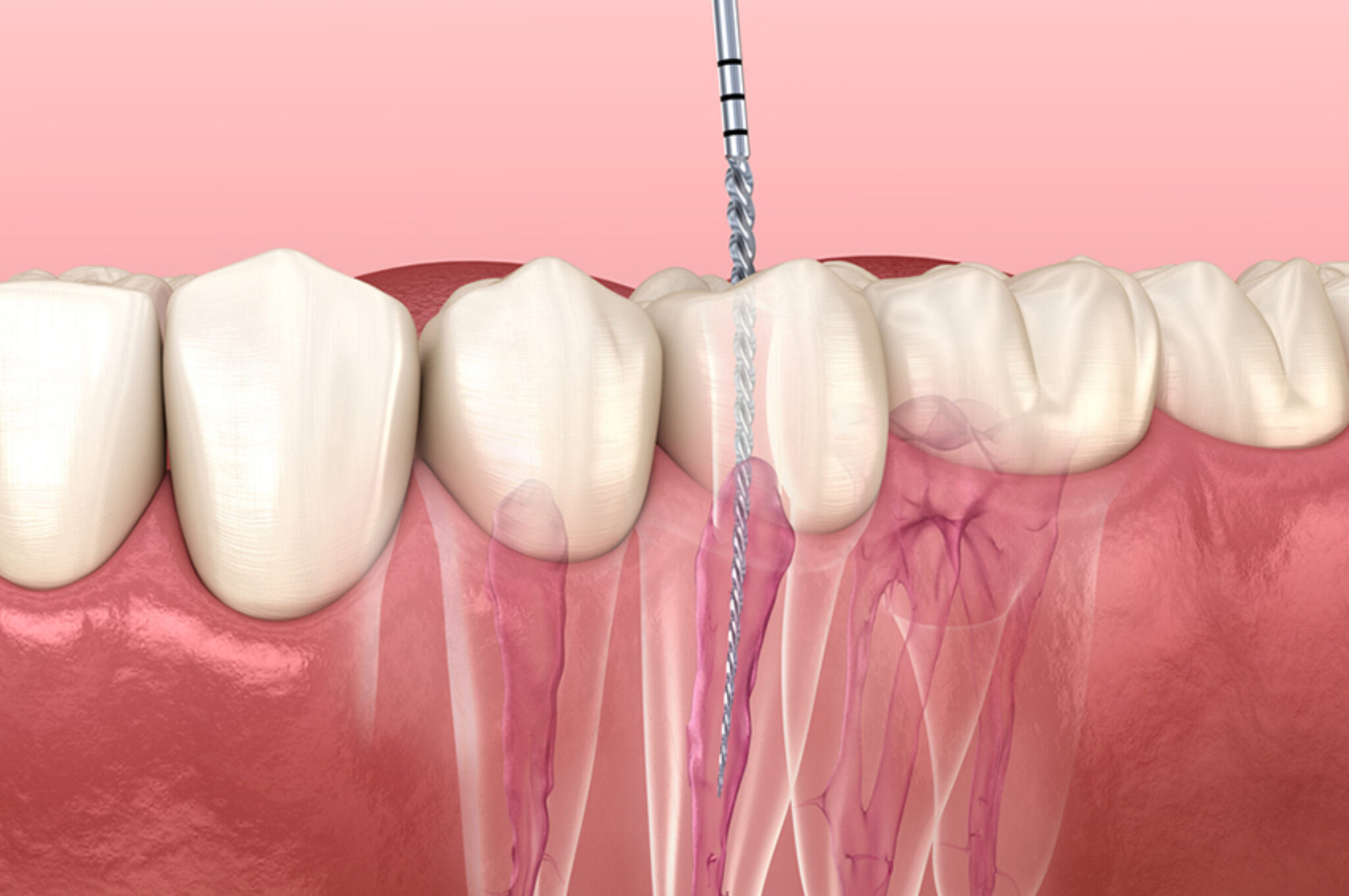Common Signs You Might Need a Root Canal - ezine articles