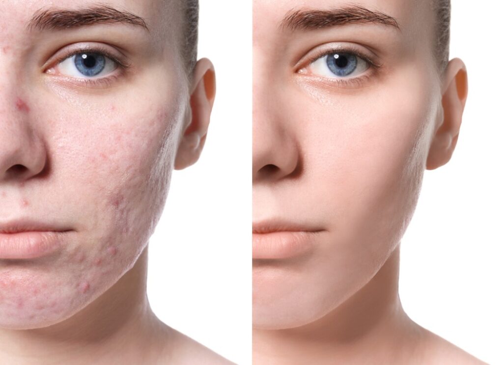 The Benefits of Microneedling for Acne Scar Treatment: A Patient's ...