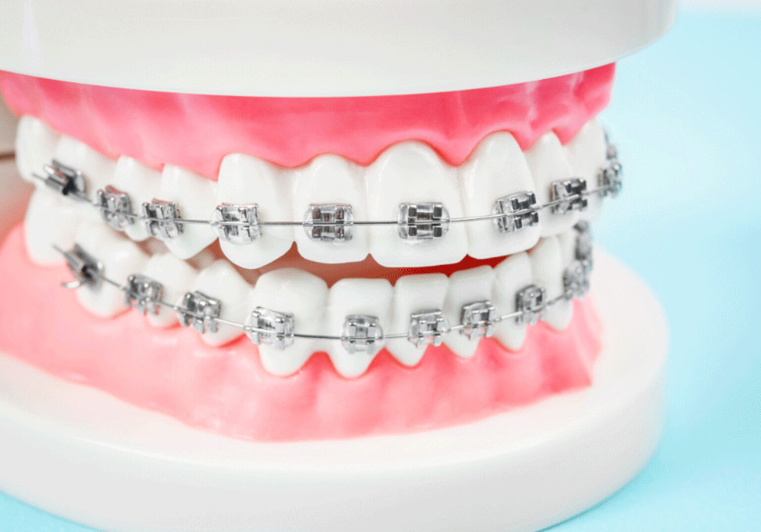 The Science Behind Metal Braces: How They Straighten Your Teeth - ezine ...