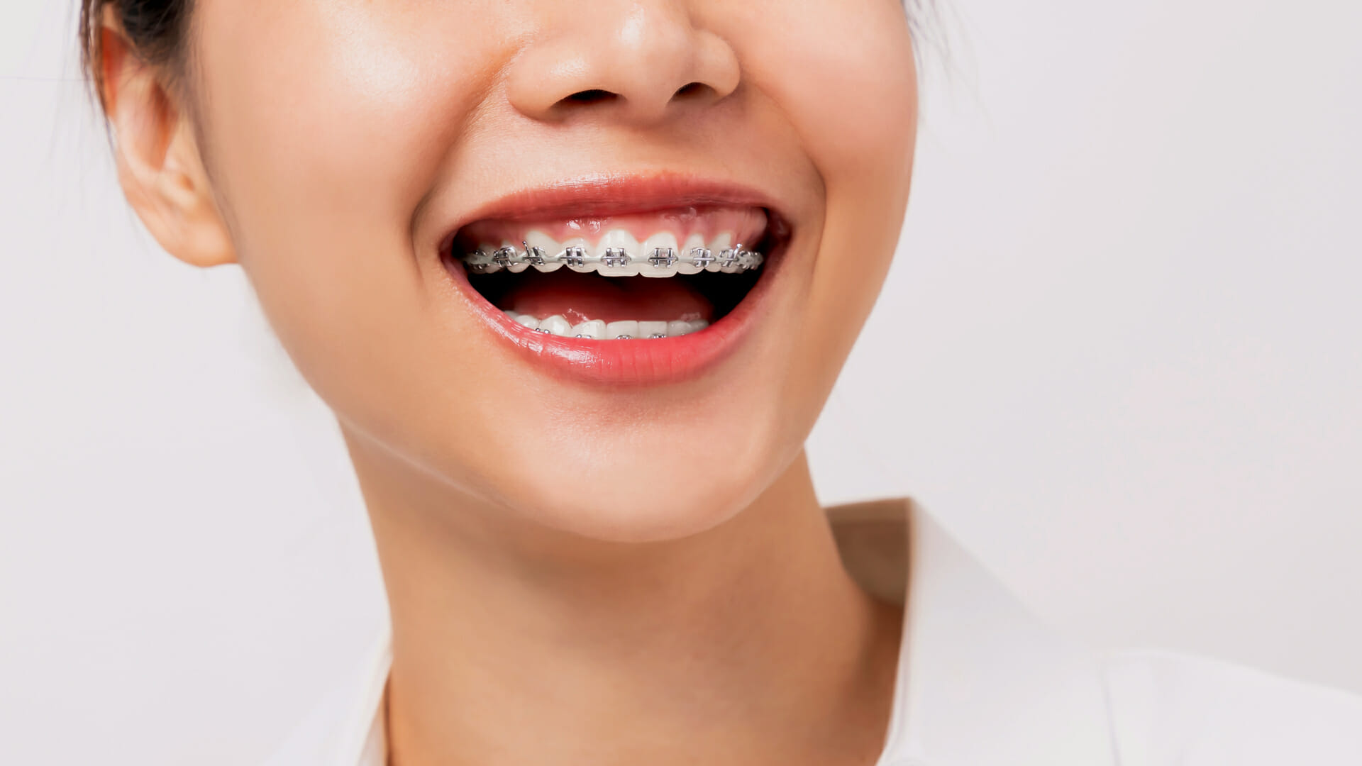 The Science Behind How Braces Straighten Your Teeth - ezine articles